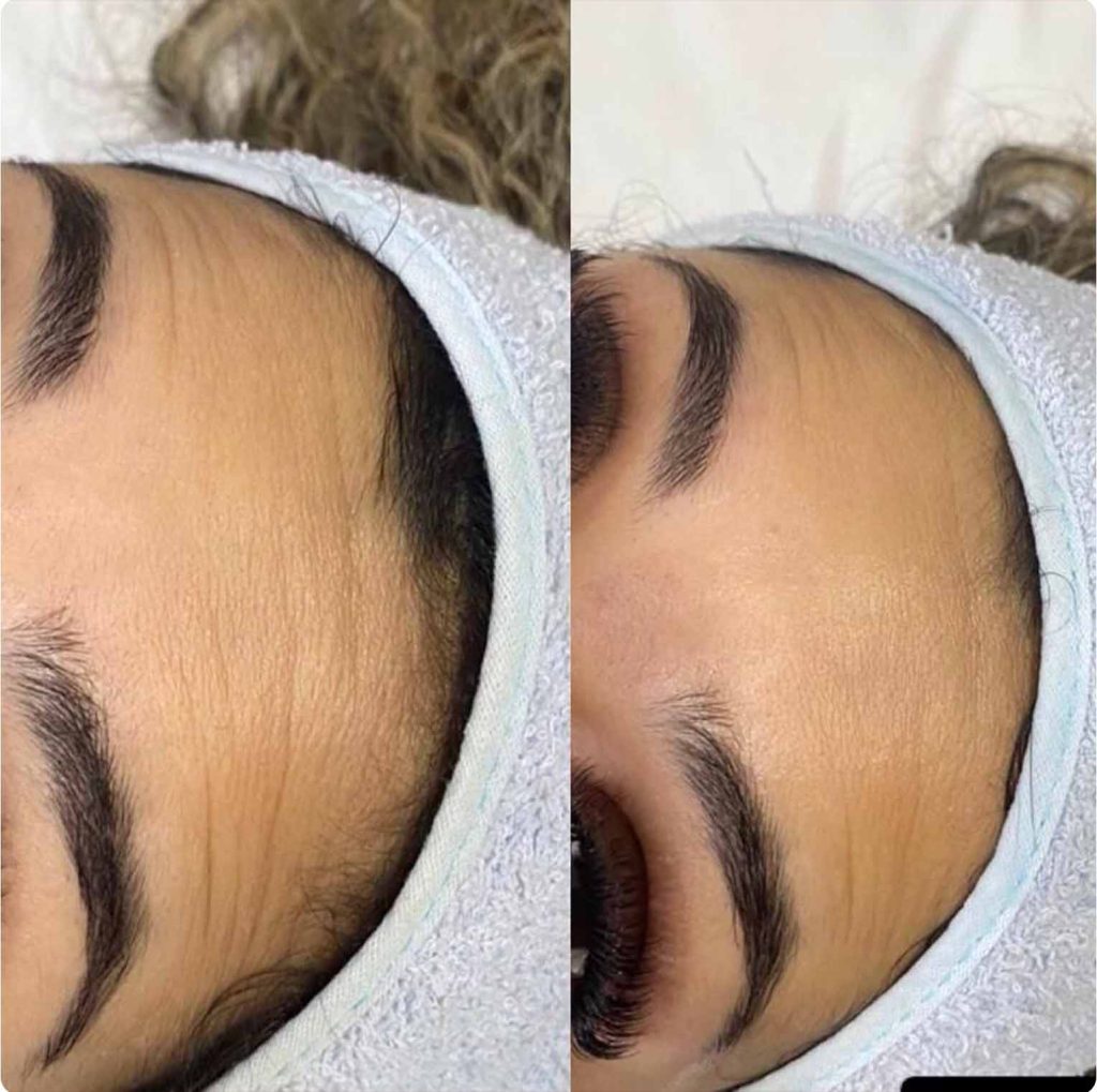 ULTRASSOM MICROFOCADO (ULTRAFOCUS) – Clínica Rennova