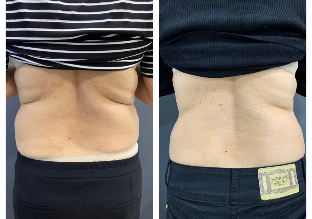 Criolipóse - Clínica Rennova