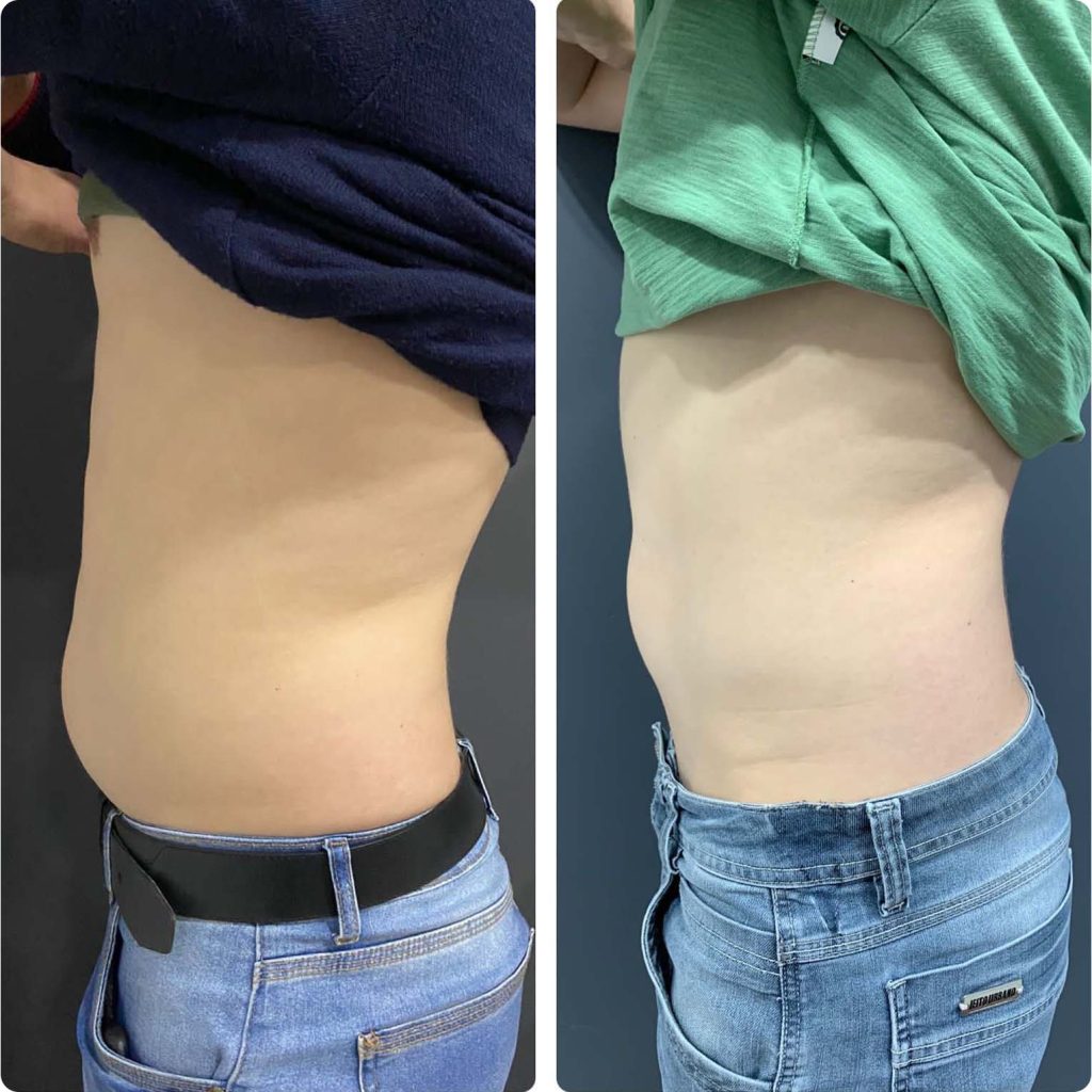 Exilis Elite - Clínica Rennova